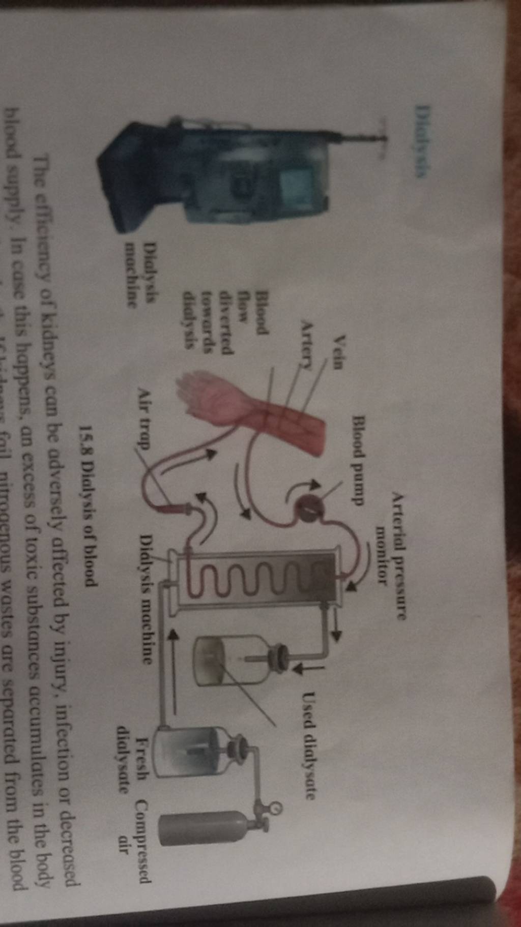 Dialysis Arterial pressure monitor Blood pump Vein Artery Blood flow dive..